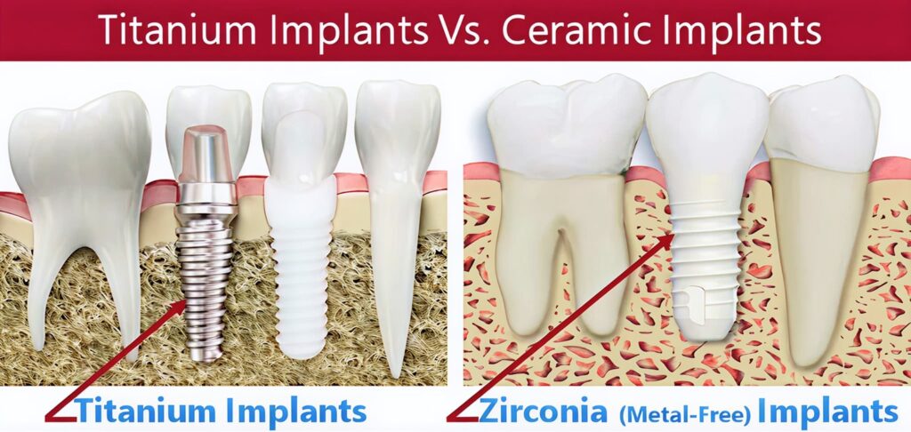 Ceramic Dental Implants Near Me in Redwood City, CA